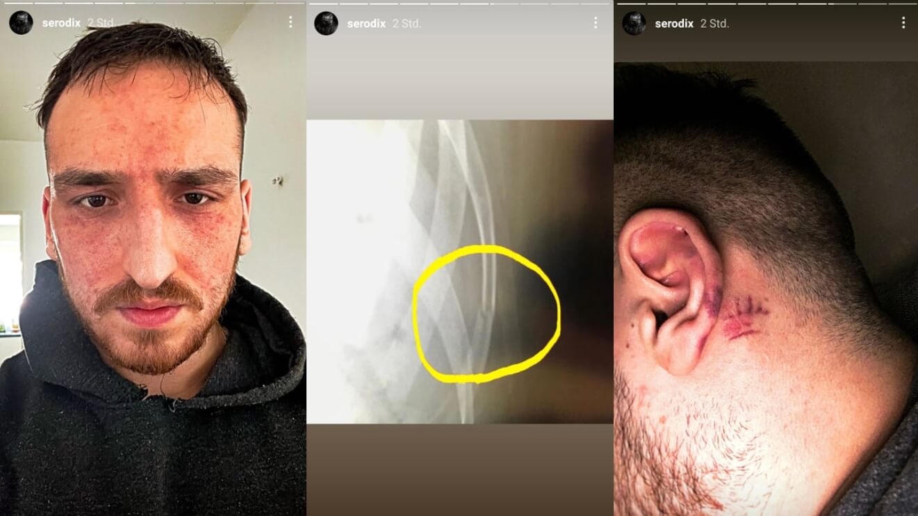 Rippenbruch, Erstickungssymptome - SeroDix zeigt Schockbilder nach ...